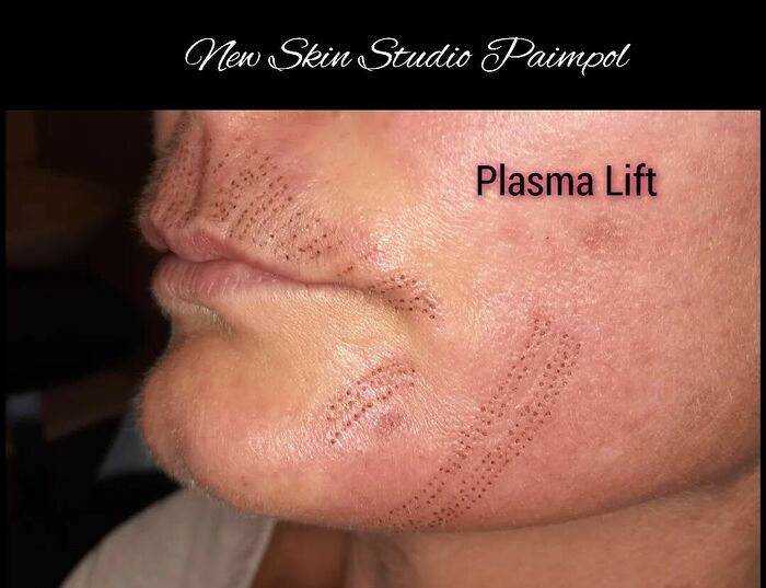 Plasma Lift